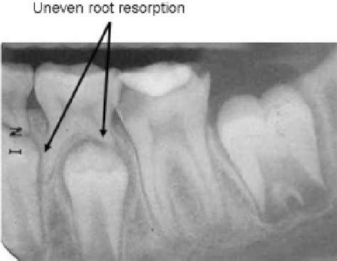 Internal Resorption Tooth X Ray At Ellen Unger Blog