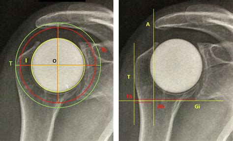 Evaluation Of Radiological Criteria Glenoid Erosion Otc Oi And Download Scientific Diagram