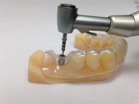 Implanting Success The State Of Dental Implants Pt Cobra Dental