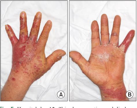 Figure 5 From Staphylococcal Scalded Skin Syndrome In A Healthy Adult