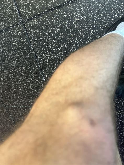 Weird Bump Near Scar Racl