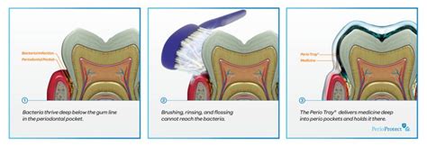 Perio Protect Wrigleyville Dental