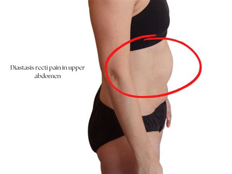 Hernia Or Diastasis Recti What Is The Difference