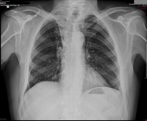 Figure 5 From Thoracic Tuberculosis A Pictorial Review Semantic Scholar