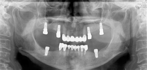 Two Bone Graft Cases Using Xenograft Materials Hiossen
