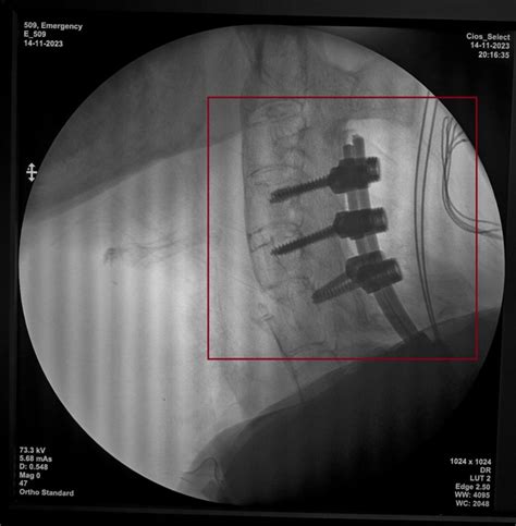 强直性脊柱炎 颈椎爆裂性骨折脱位这家医院成功手术让他免于全身瘫痪