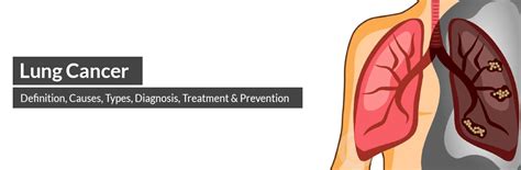 Lung Cancer Causes Types Diagnosis Treatment Prevention And Cost