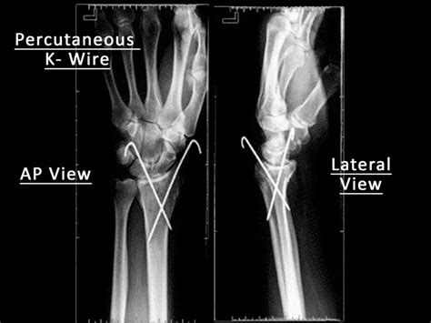 Distal End Radius Fractures Colles Smiths And Bartons Pptx
