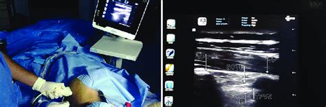 Thoracic Paravertebral Block Procedure A The Needle And Probe