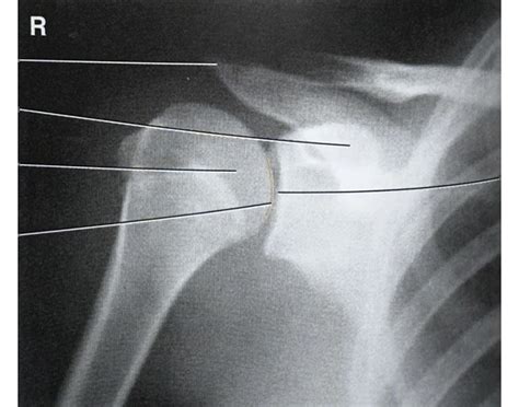 Grashey Method Ap Oblique X Ray Anatomy Quiz