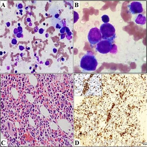 Bone Marrow Aspirate A B And Biopsy C D Showing Infiltration By