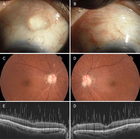 Anterior Segment Photographs A B Fundus Photographs C D And Download Scientific Diagram