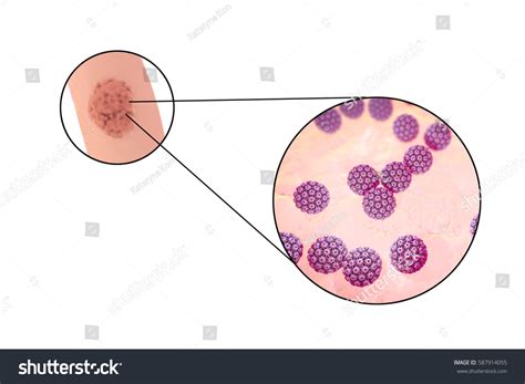 Human Papillomavirus Hpv Lesions Men Genital ภาพประกอบสต็อก 587914055