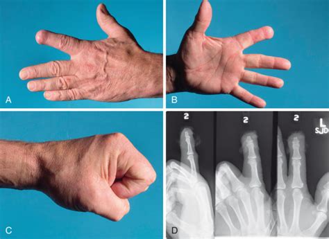 Digital Amputations Musculoskeletal Key