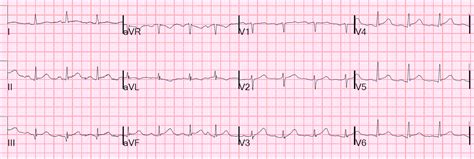 Dr Smiths Ecg Blog Ventricular Fibrillation Resuscitation And Hyperacute T Waves What Does