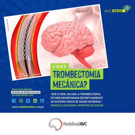 Trombectomia Mecânica O Que é Stroke Beyond Borders