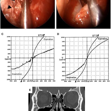 Intraoperative Findings Ab The Submucosal Tissue With Severe
