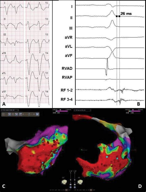 Electrocardiogram And Electro Anatomical Maps Of Case 1 A Twelve Lead