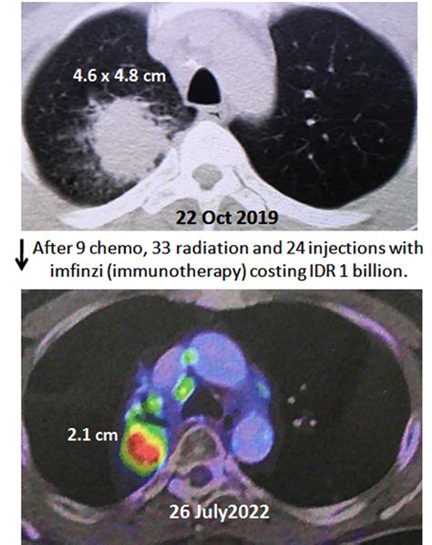 Fighting Lung Cancer With Chemotherapy Radiotherapy And Immunotherapy