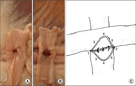Sequential Anastomosis Using A Continuous And B Interrupted Download Scientific Diagram
