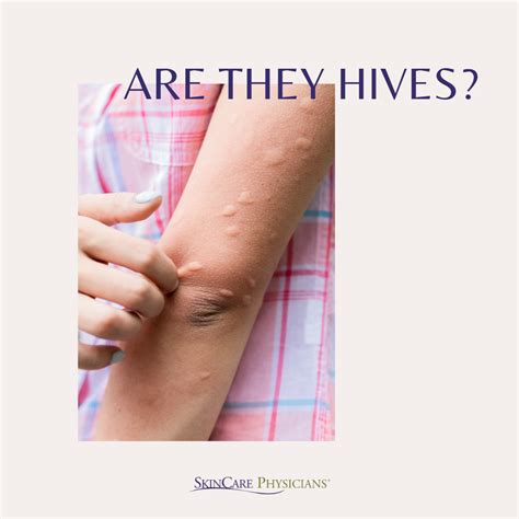Hives On Skin