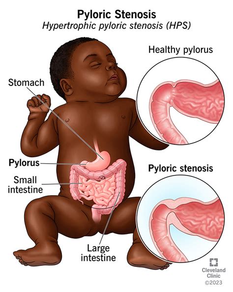 Pyloric Stenosis Hps Symptoms Causes 49 Off