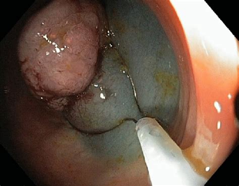 Endoscopic Image The Same Polyp As In Figs 1 And 2 The Polypectomic Download Scientific