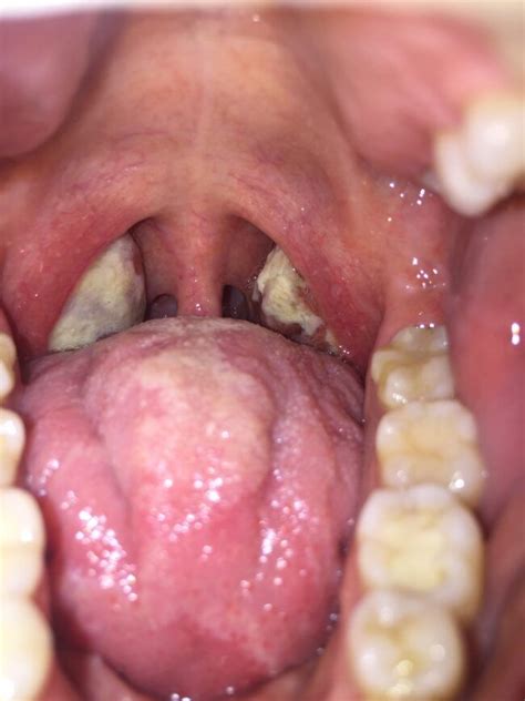 La Desconocida Realidad De La Amigdalitis