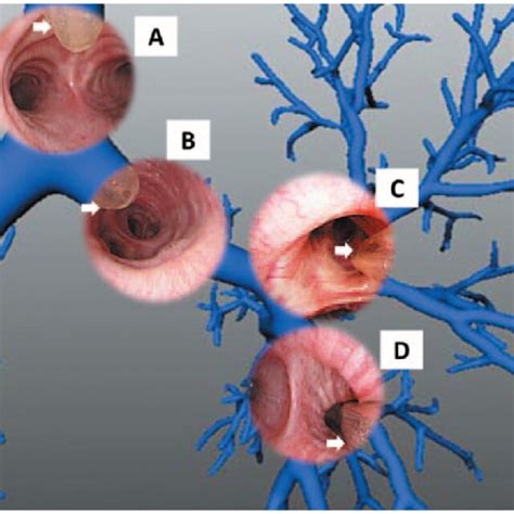 Example Of The Endo Bronchial Etco2 Test The Arrow Points To The Tip