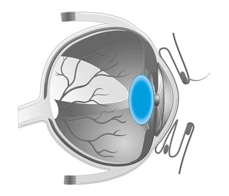 Lens