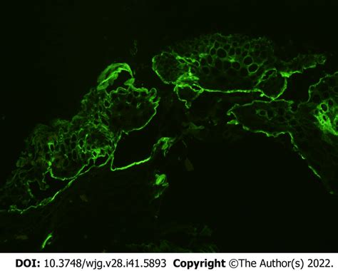 Direct Immunofluorescence Fibrinogen Deposits In The Basal Membrane As Download Scientific
