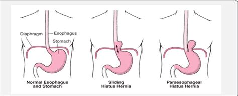 Herniated Esophagus Hiatal Hernia Hernia Gastroenterology Spectrum