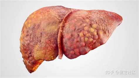 肝吸虫感染会导致肝癌、肝胆管癌 知乎