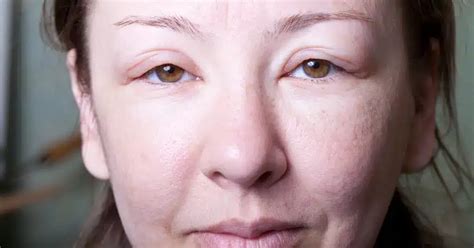 Keratitis Vs Conjunctivitis Understanding The Differences And Symptoms