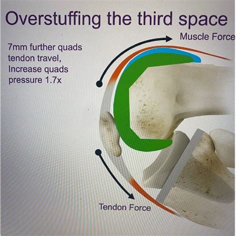Using The Tibial Stylus To Measure Projected Anterior Resection