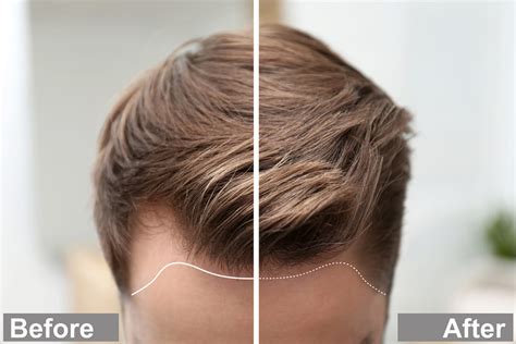 What Is The Hair Transplant Success Rate Elithair