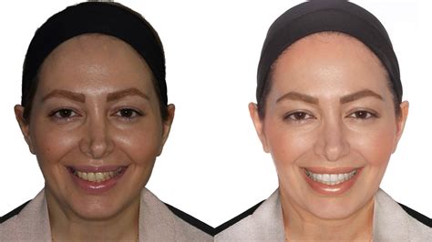 ارتودنسی دیپ بایت ناقرینه دکتر داودیان نماشا