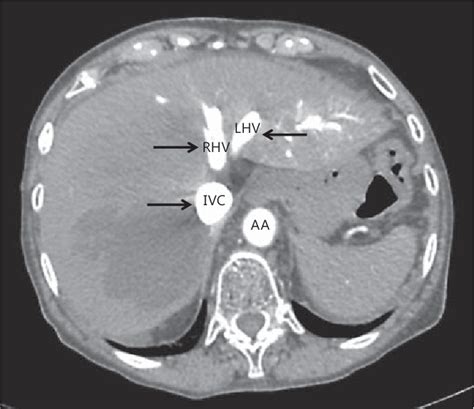 Figure 3 From Carcinoid Heart Disease From Pathophysiology To