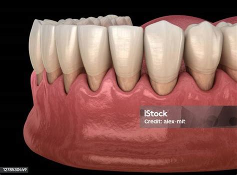 잇몸 경기 침체 과정 의학적으로 정확한 3d 일러스트레이션 감소에 대한 스톡 사진 및 기타 이미지 감소 디지털 생성 이미지 박테리아 Istock