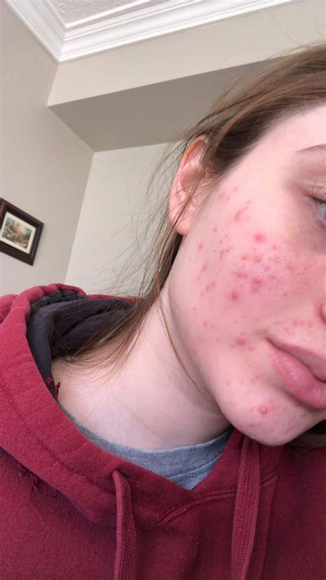 Did 60 Mg For 6 Months Three Years Ago Accutane Was The Best Decision