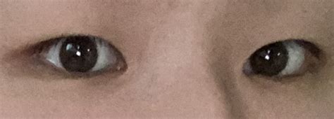 자연유착 라이너트임 눈매교정 후기 리얼후기 눈이 예쁘다그래서 아몬드성형외과