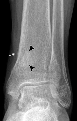 Stress Fracture X Ray Tibia Stress Fracture X Ray Tibia