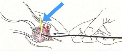 Pacemaker Implant And Complications Review Flashcards Quizlet