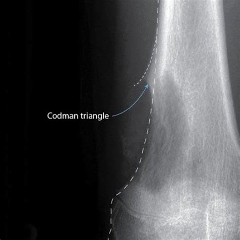 A Codman Triangle Is A Type Of Periosteal Reaction Seen With Aggressive