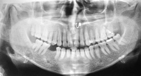 Osteosarcoma Jaw X Ray