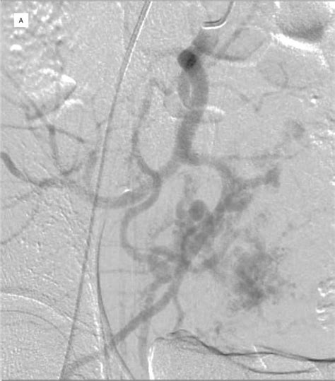 Imaging And Devascularisation Of Rare Hypervascular Placental Site Trophoblastic Tumour Eurorad