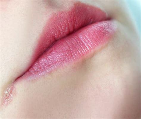 Angular Cheilitis Home Remedies The Organic Beauty Expert