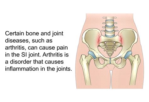 Si Fusion Sacroiliac Joint Fusion