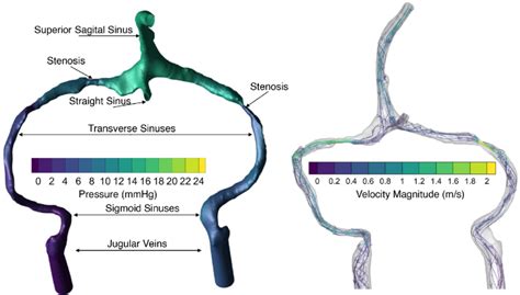 Schematic Of Dural Venous Sinus Manometry With Cfd Generated Time