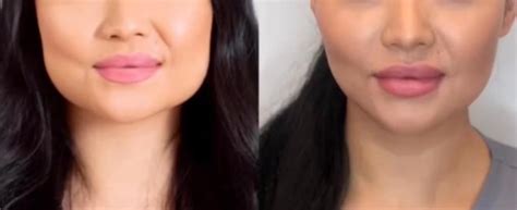Why You Should Consider Masseter Muscle Botox 5 Benefits With Skin Technique Skin Technique